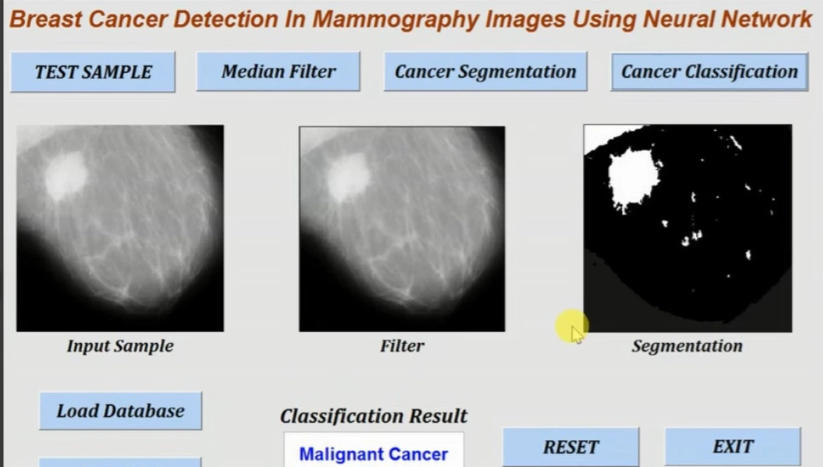 Breast Cancer Detection: Tutorial to Mammography Analysis